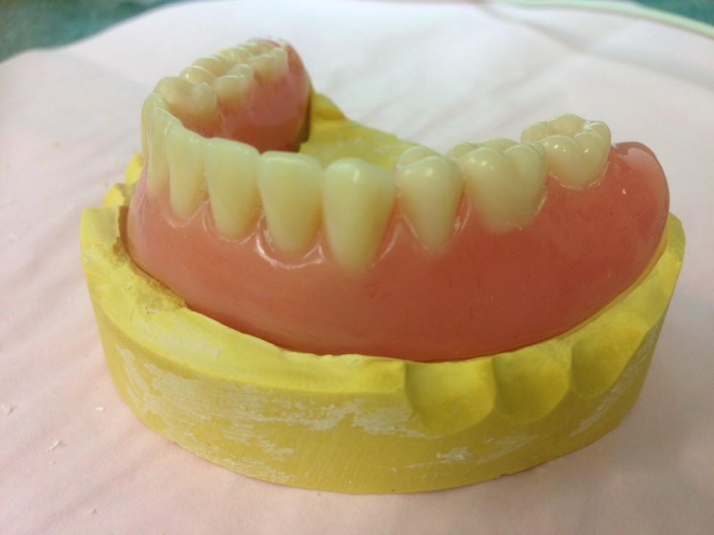 Photo Gallery-Implant Retained Denture | Facial Surgery UK